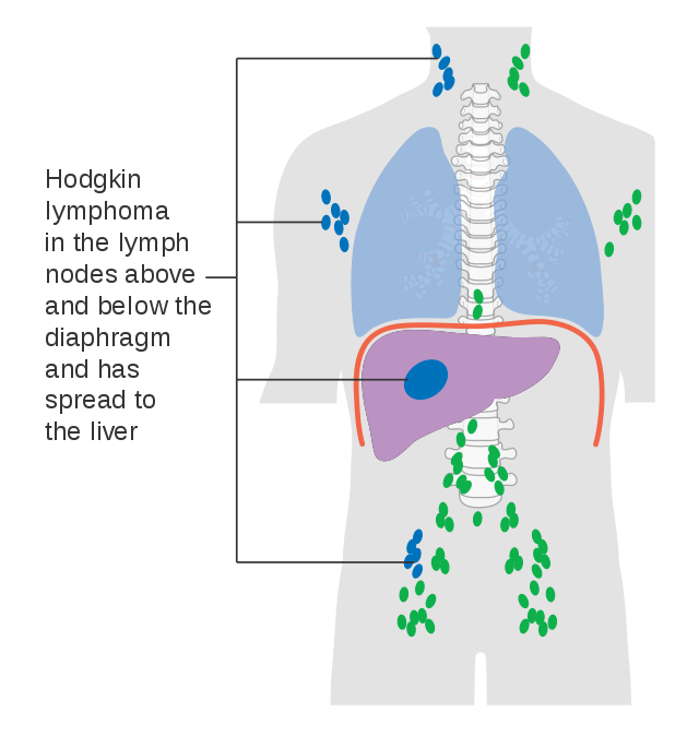 Stage 4 Diffuse Large B-Cell Non-Hodgkin Lymphoma Diagnosis
